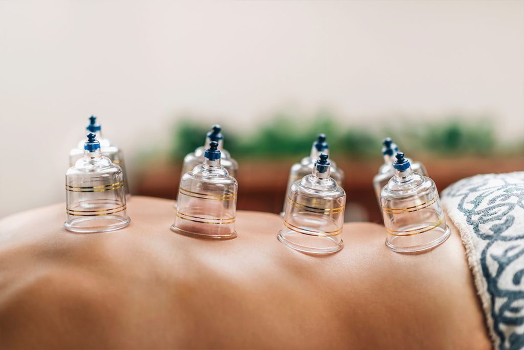 Cupping in Jumeirah Therapy | Water Spa Dubai